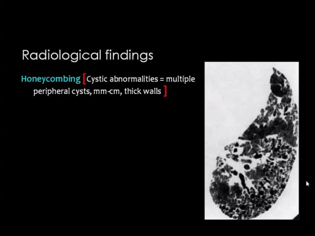 HRCT Reticular pattern | PPT