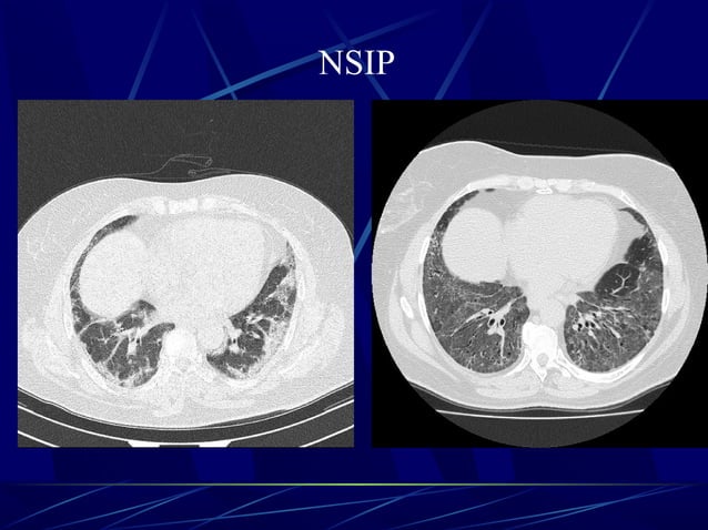 HRCT Reticular pattern | PPT