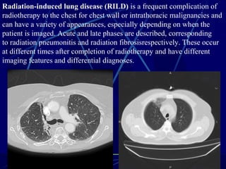 HRCT Reticular pattern | PPT