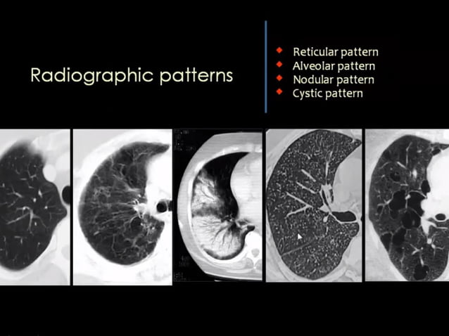 HRCT Reticular pattern