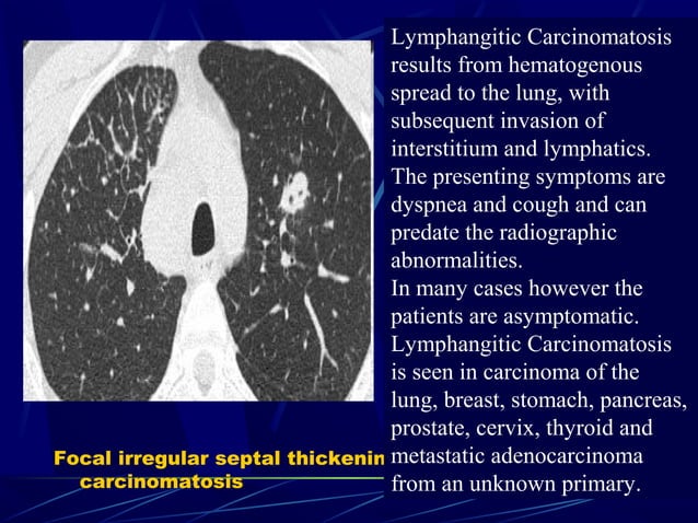 HRCT Reticular pattern