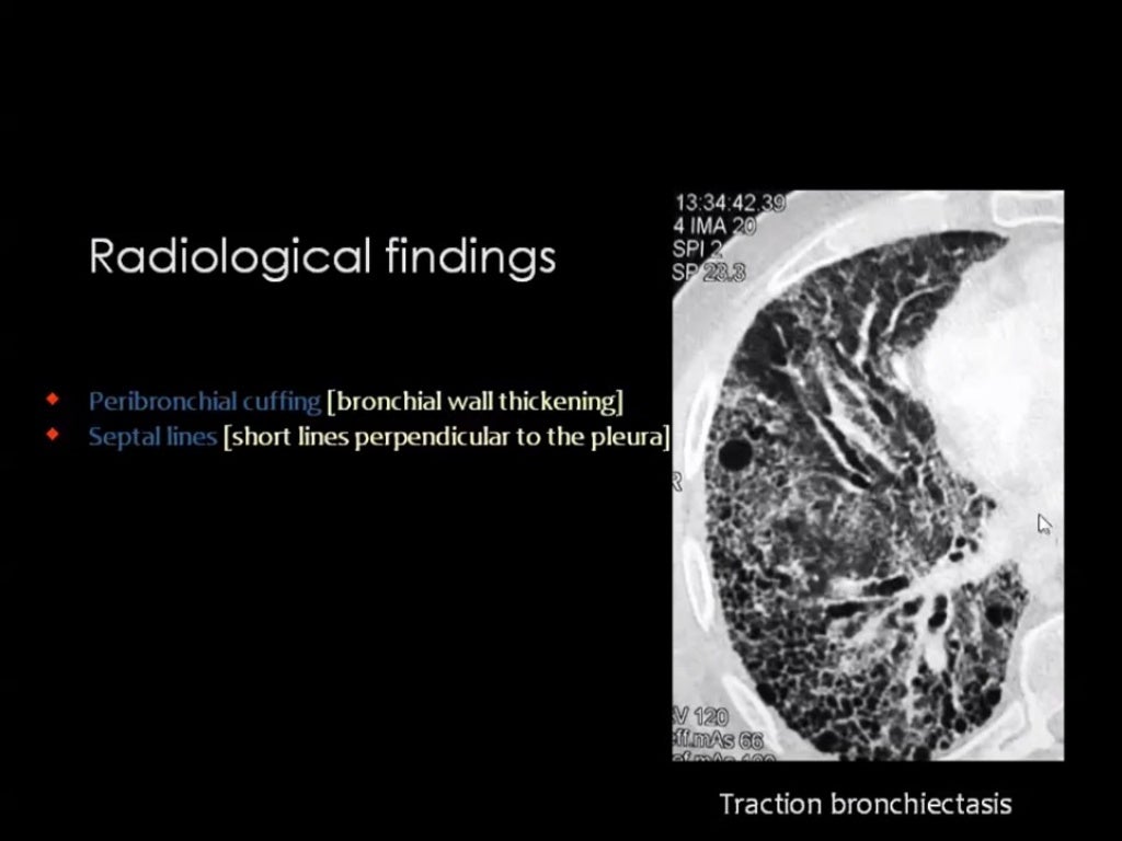 HRCT Reticular pattern