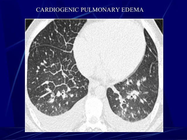 HRCT Reticular pattern
