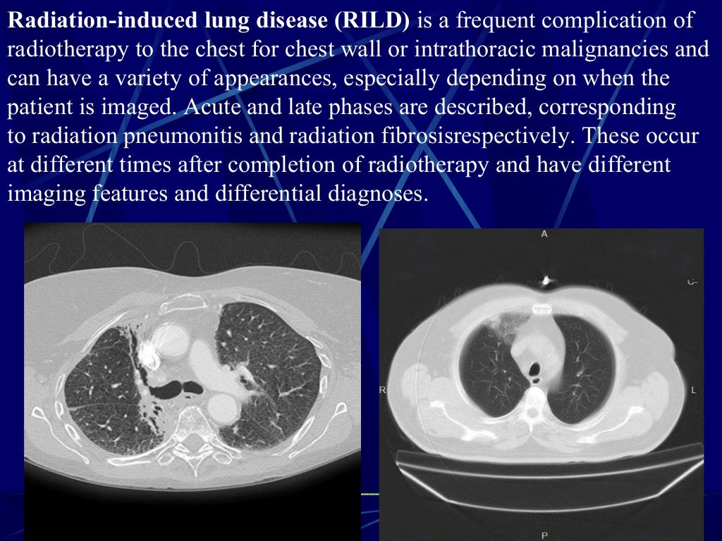 HRCT Reticular pattern