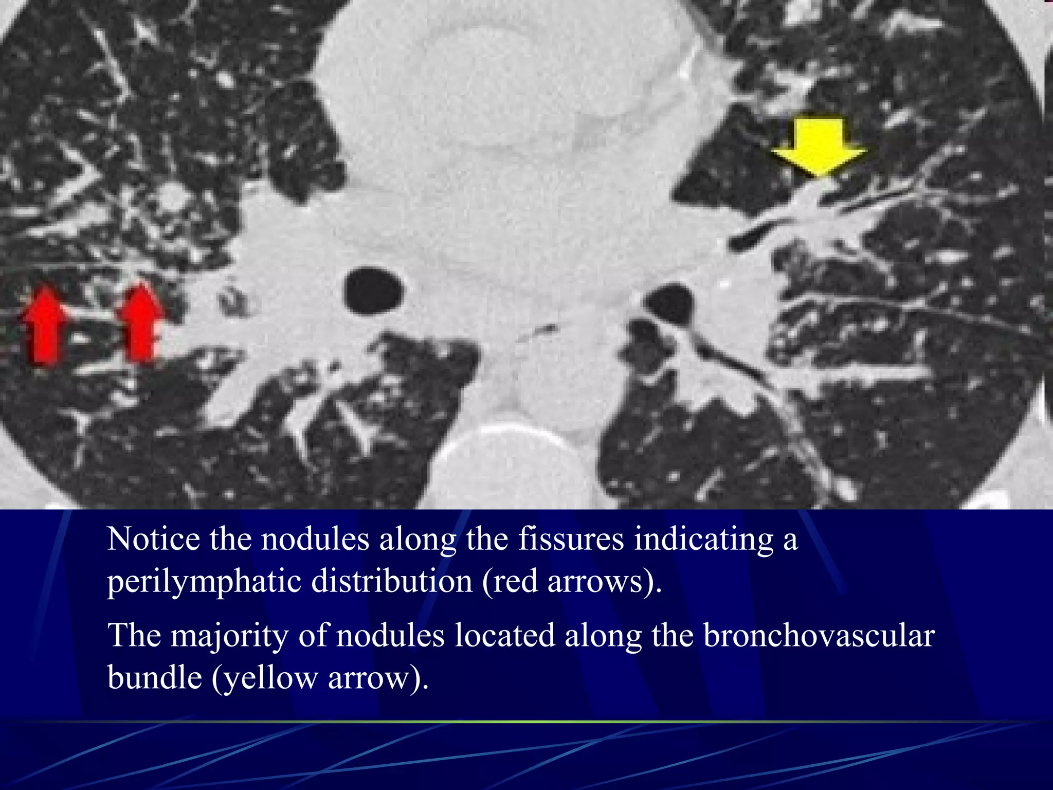HRCT Nodular pattern | PPT