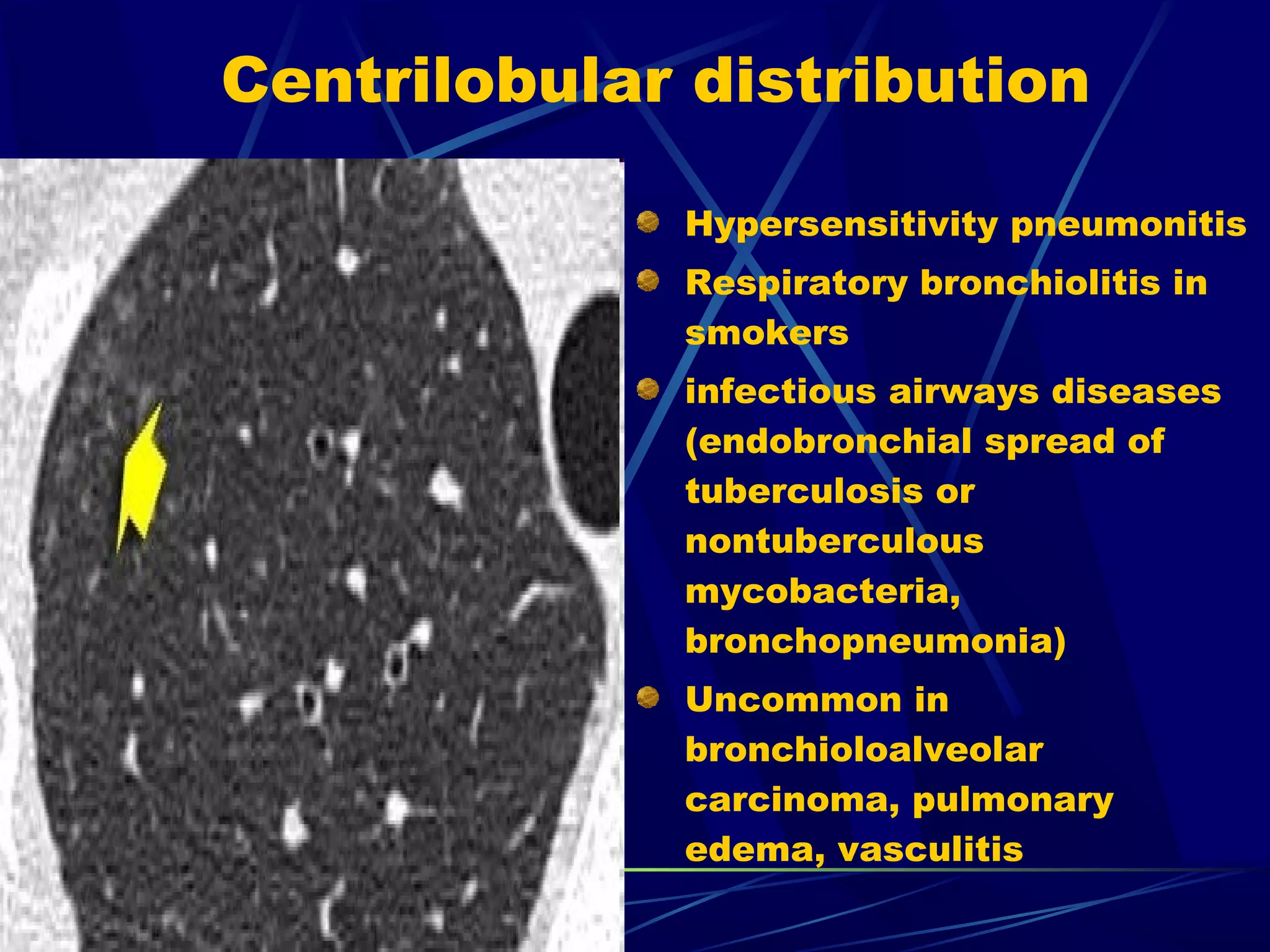 HRCT Nodular pattern | PPT