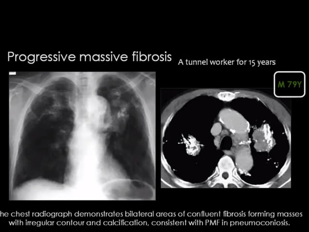 HRCT Nodular pattern | PPT