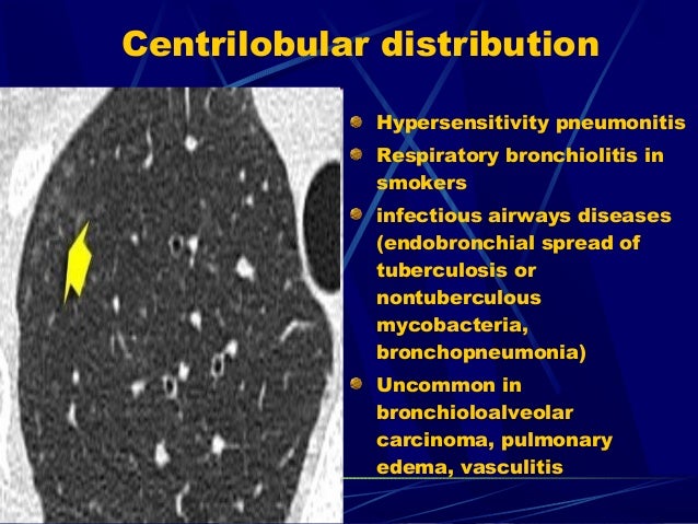 HRCT Nodular pattern