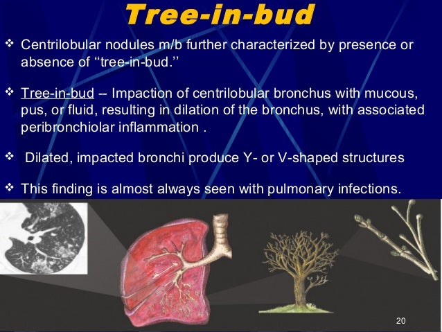 HRCT Nodular pattern