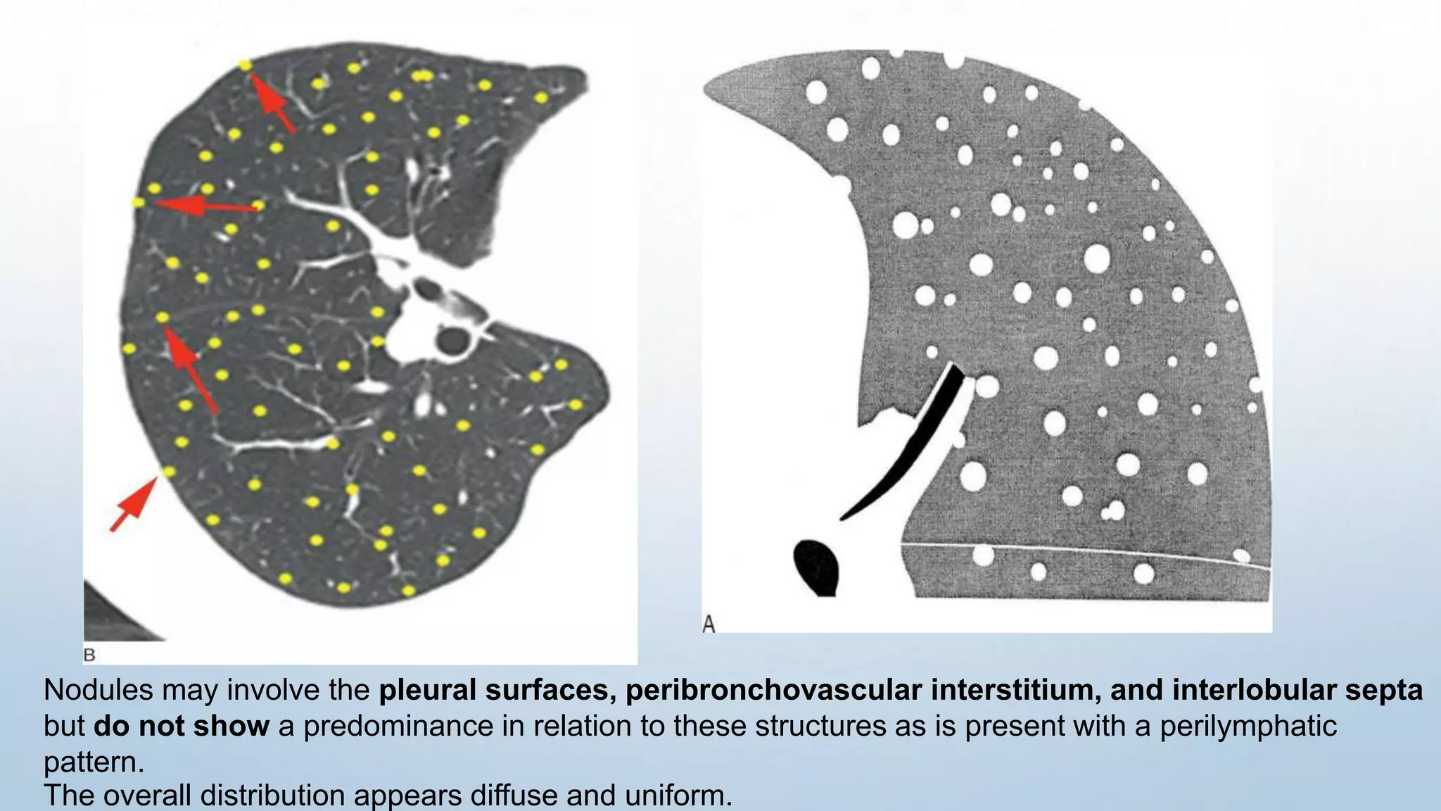 hrct.pptx high resolution ct patterns | PPTX