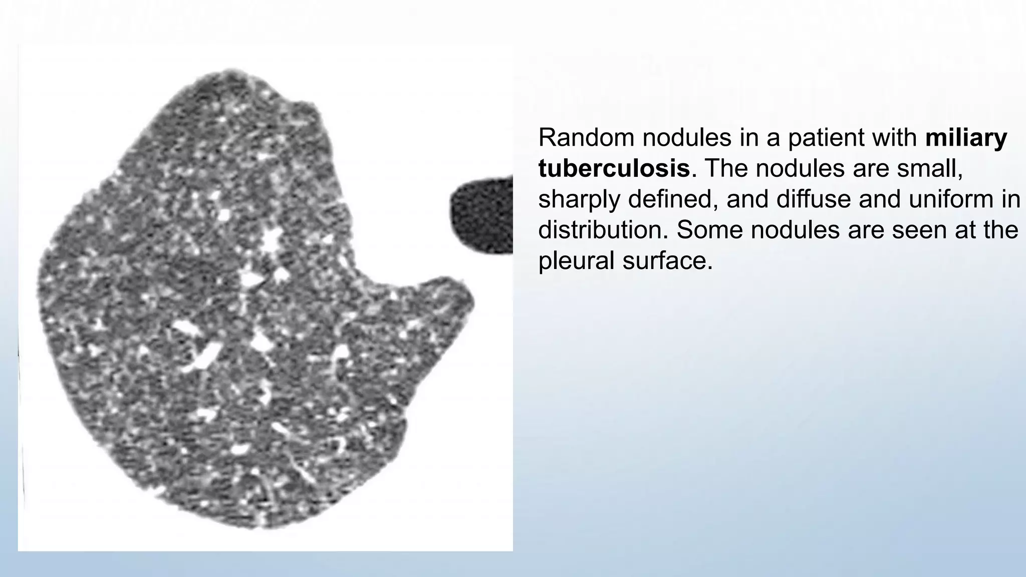 hrct.pptx high resolution ct patterns | PPTX