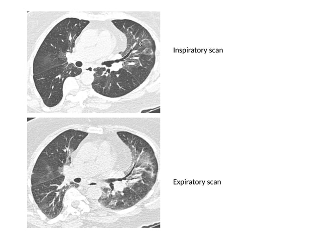 HRCT patterns in interstitial lung disease | PPTX