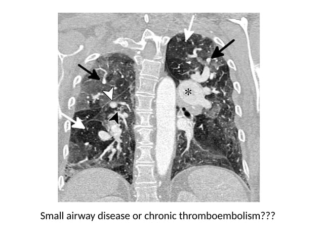 HRCT patterns in interstitial lung disease | PPTX