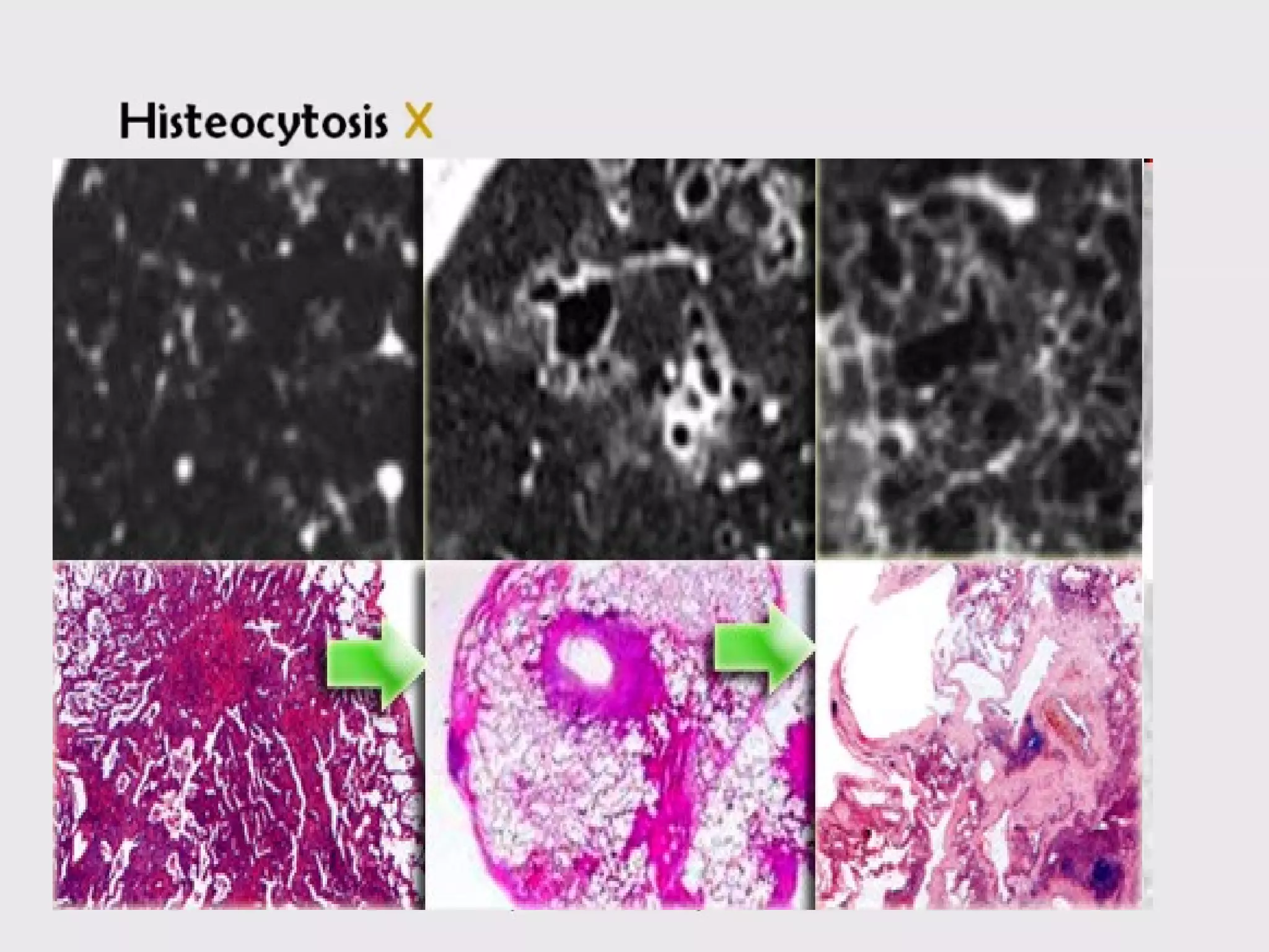 HRCT Low attenuation pattern | PPT