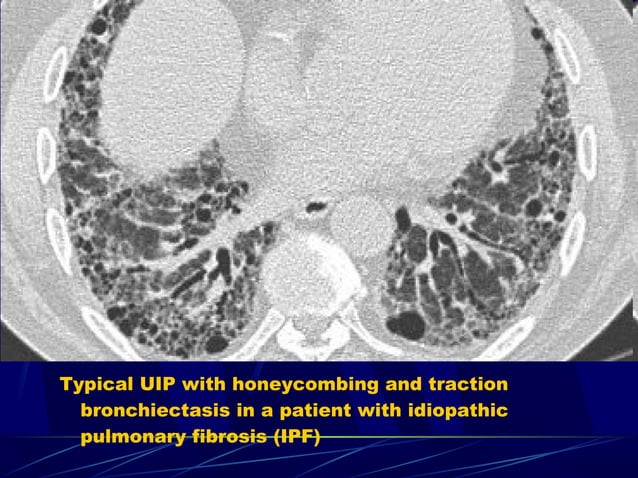 HRCT Low attenuation pattern | PPT