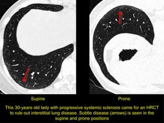 HRCT in Diffuse Lung Diseases - I (Techniques and Quality) | PPT