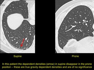 HRCT in Diffuse Lung Diseases - I (Techniques and Quality) | PPT | Lung ...