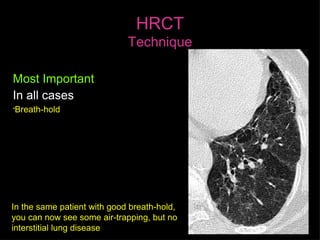 HRCT in Diffuse Lung Diseases - I (Techniques and Quality) | PPT | Lung ...