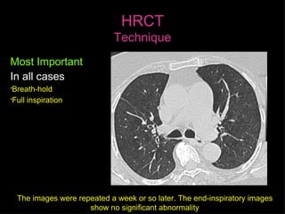 HRCT in Diffuse Lung Diseases - I (Techniques and Quality) | PPT | Lung ...