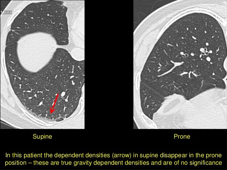 HRCT in Diffuse Lung Diseases - I (Techniques and Quality)