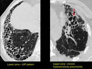 HRCT in Diffuse Lung Diseases - II (Honeycombing, UIP pattern, IPF) | PPT