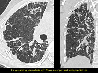 HRCT in Diffuse Lung Diseases - II (Honeycombing, UIP pattern, IPF) | PPT