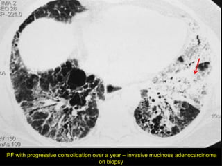 HRCT in Diffuse Lung Diseases - II (Honeycombing, UIP pattern, IPF) | PPT