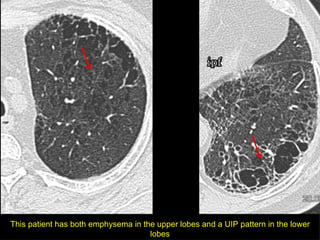 HRCT in Diffuse Lung Diseases - II (Honeycombing, UIP pattern, IPF ...
