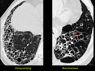HRCT in Diffuse Lung Diseases - II (Honeycombing, UIP pattern, IPF) | PPT