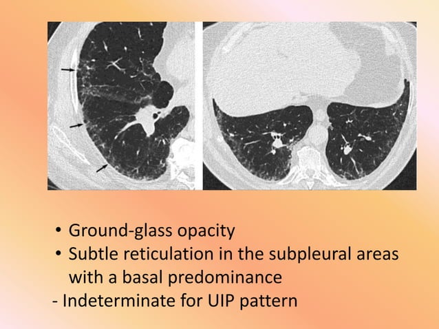 HRCT basics of UIP POSTER.pptx | Lung and Respiratory Health | Diseases ...