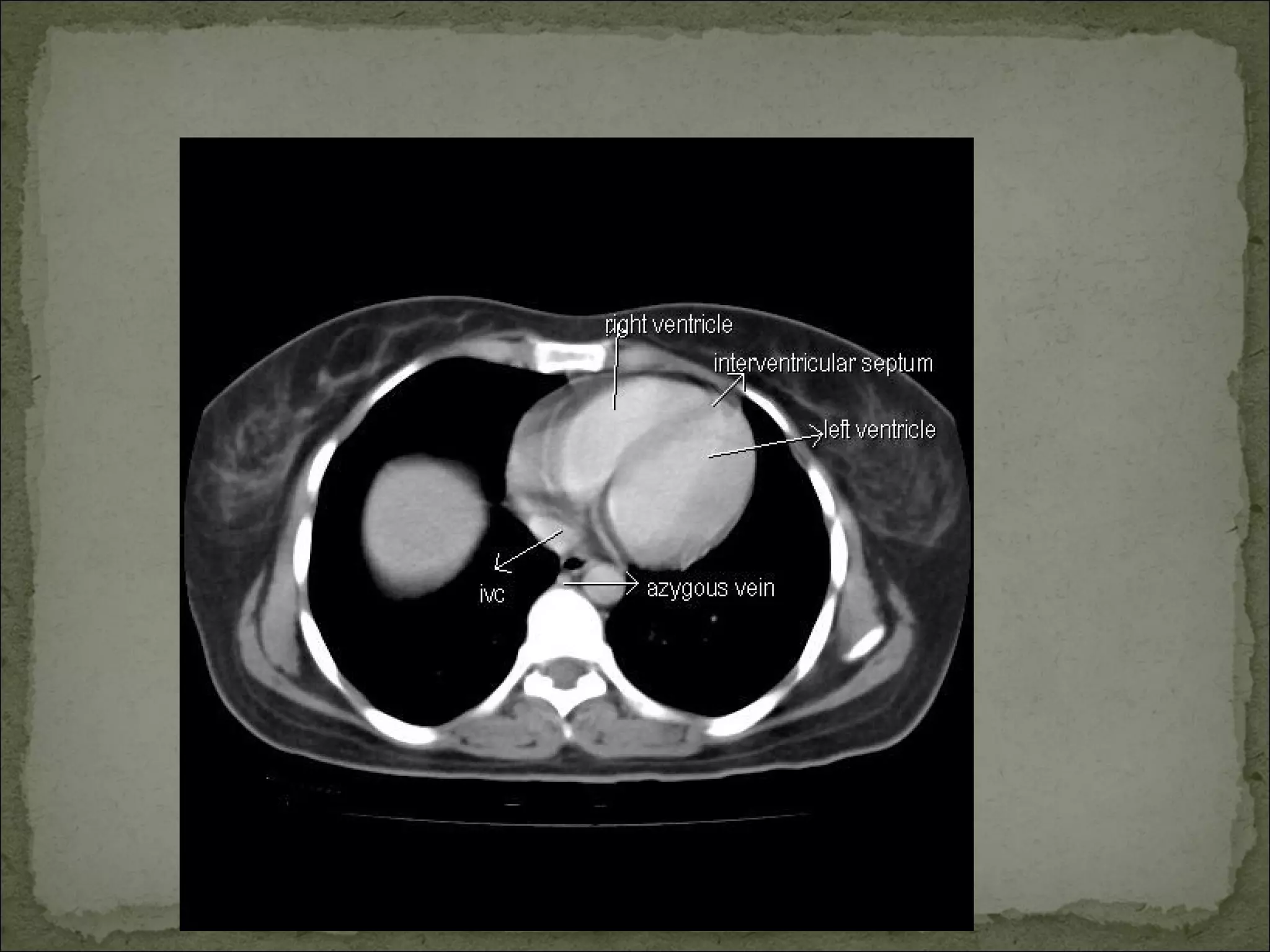 Hrct anatomy | PPT | Lung and Respiratory Health | Diseases and Conditions