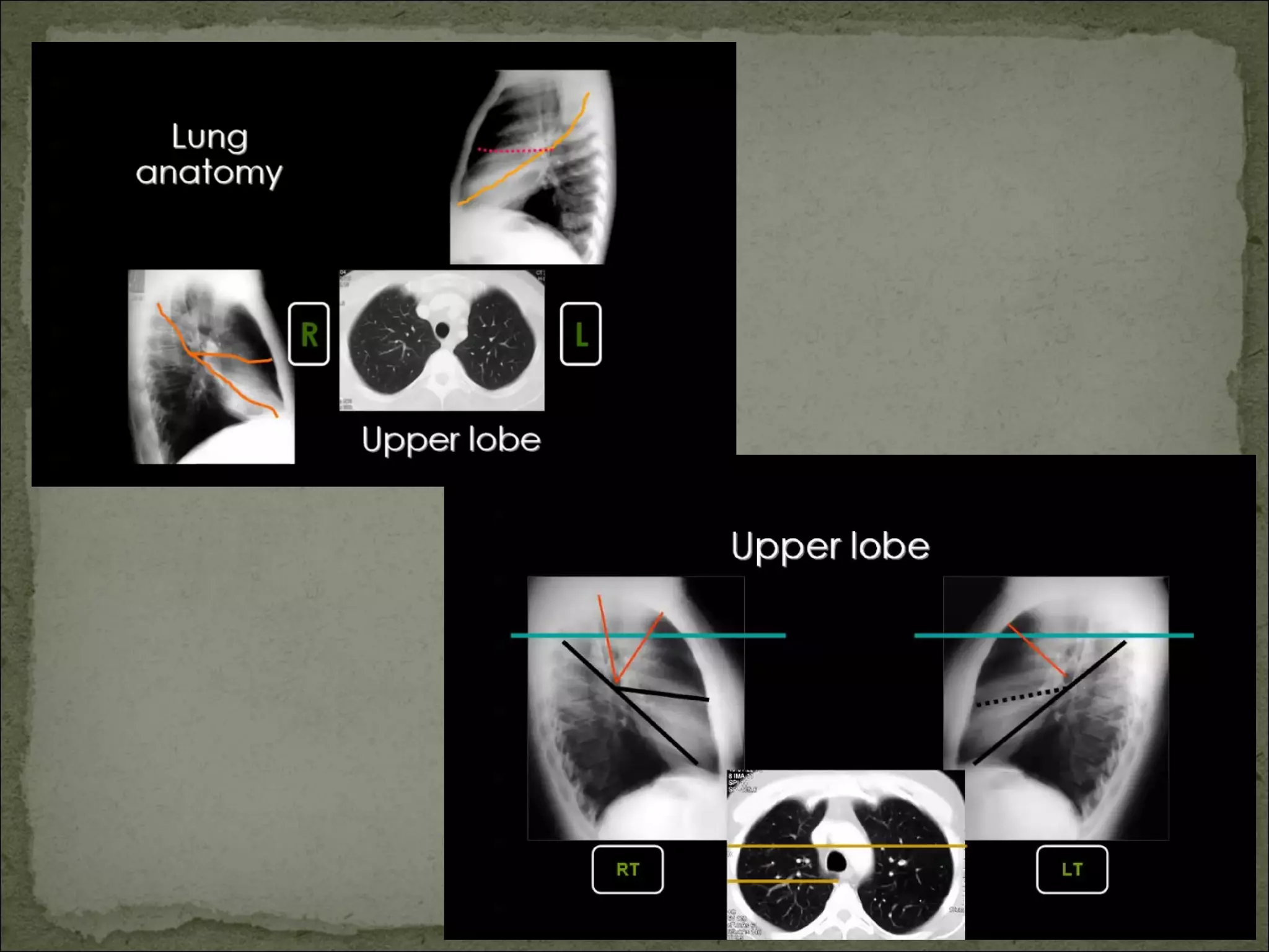 Hrct anatomy | PPT | Lung and Respiratory Health | Diseases and Conditions