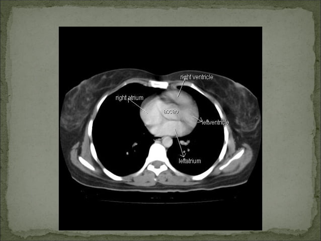 Hrct anatomy | PPT | Lung and Respiratory Health | Diseases and Conditions