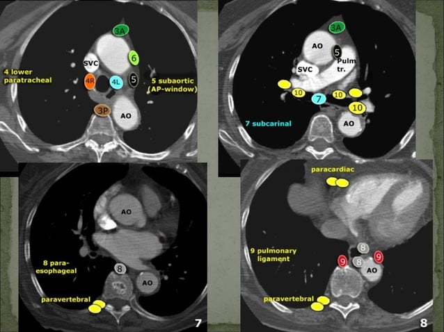 Hrct anatomy | PPT | Lung and Respiratory Health | Diseases and Conditions