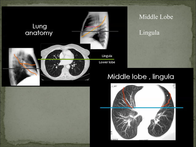 Hrct anatomy | PPT | Lung and Respiratory Health | Diseases and Conditions