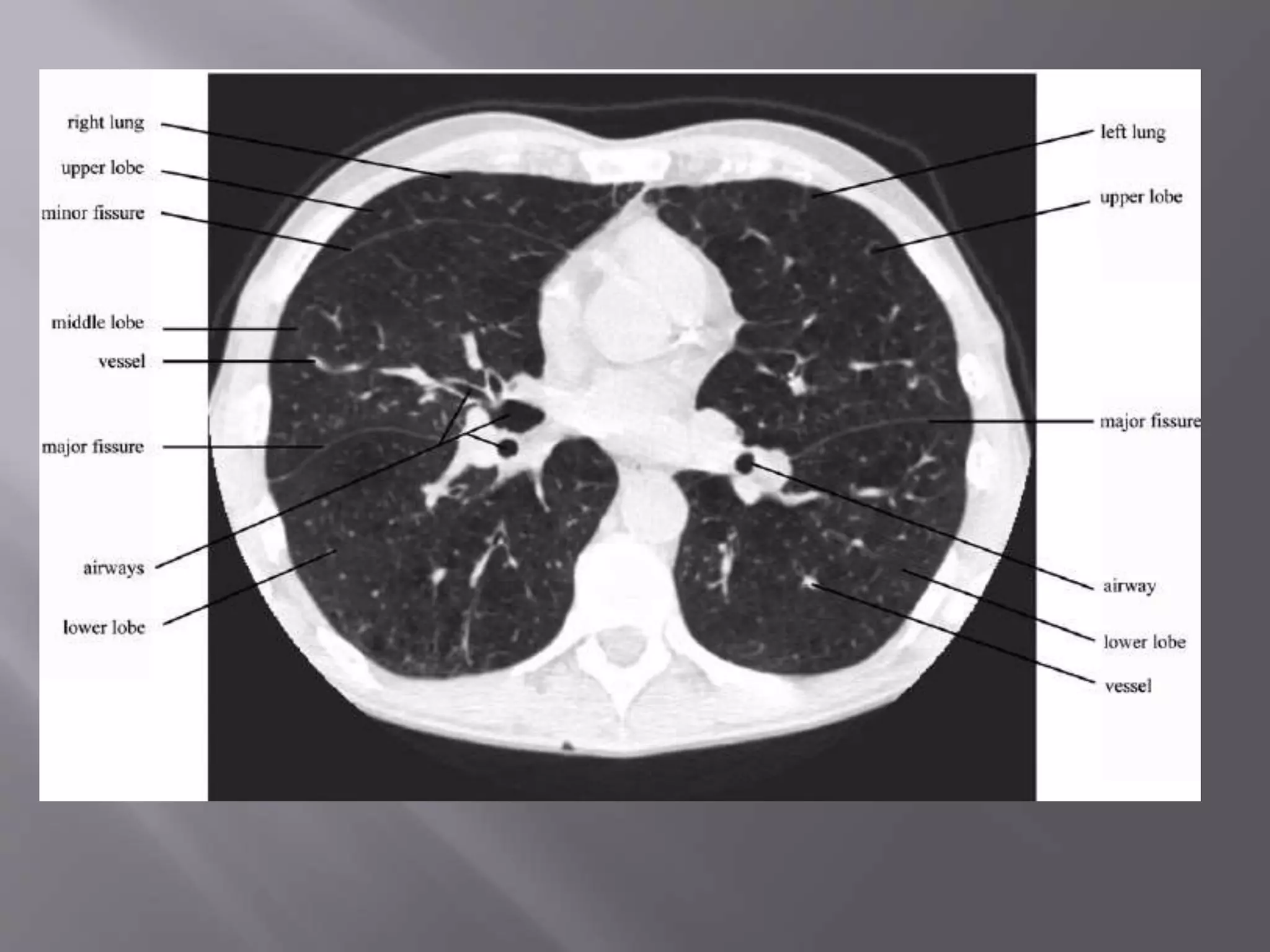HR CT CHEST.pptx