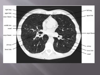 HR CT CHEST.pptx