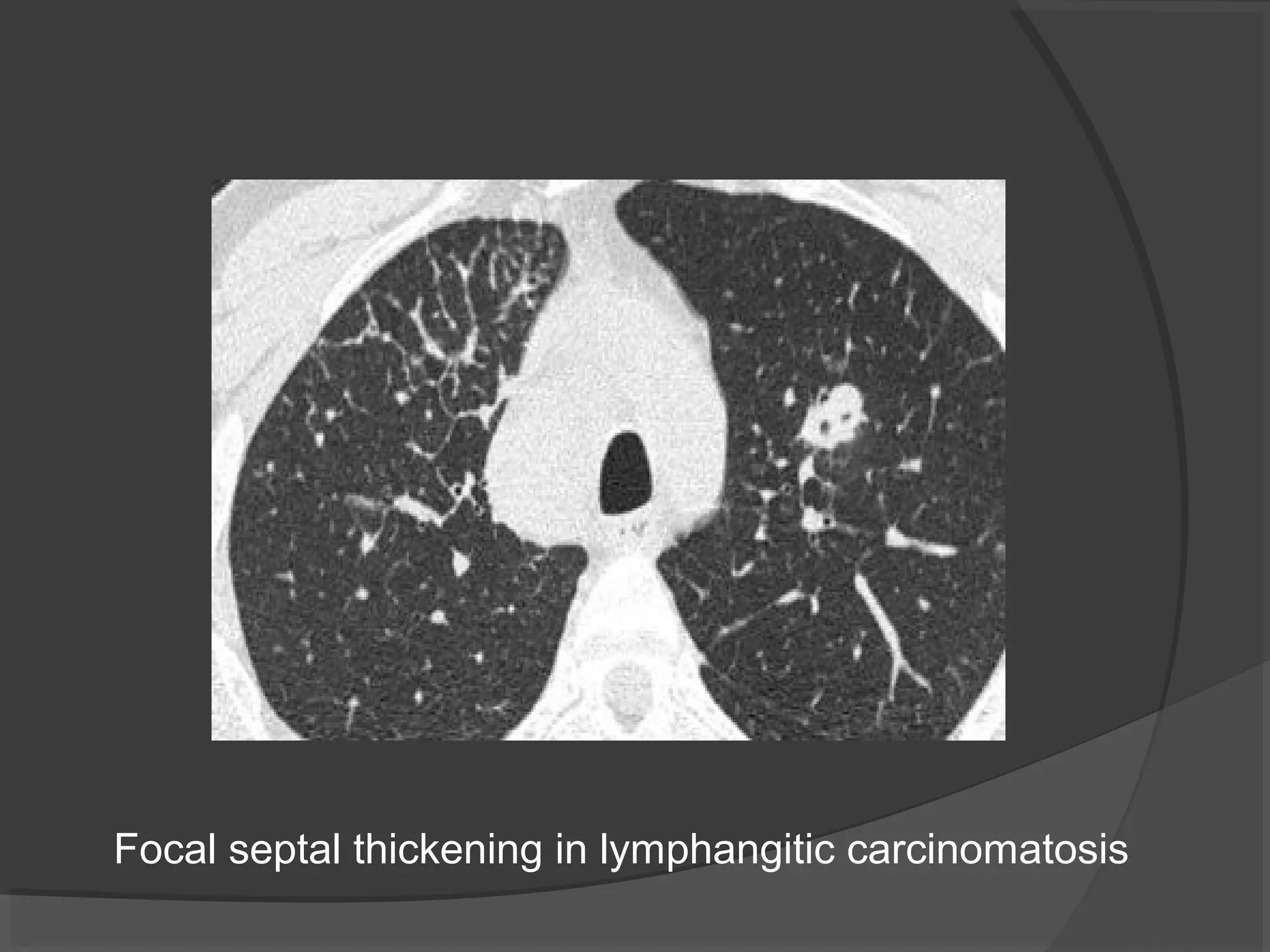 Hrct chest technique and interpretation | PPT