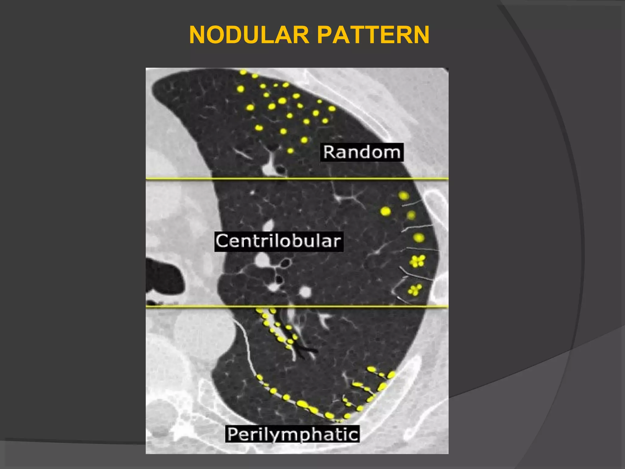 Hrct chest technique and interpretation | PPT