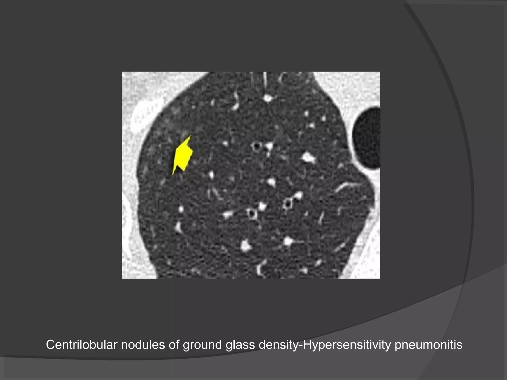 Hrct chest technique and interpretation | PPT
