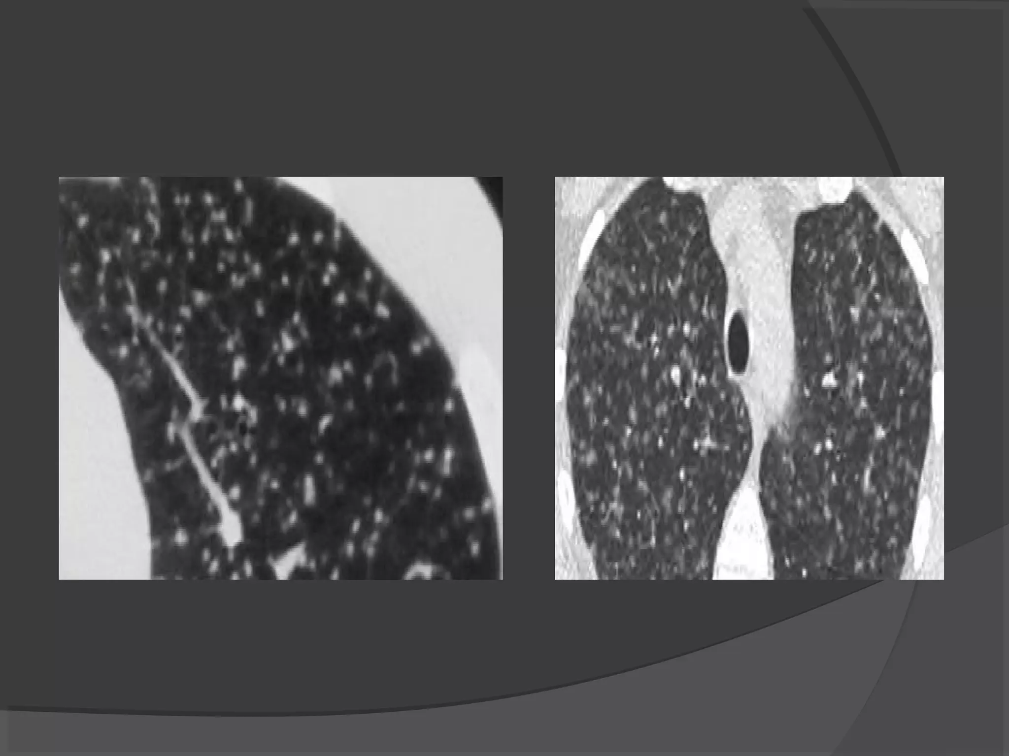Hrct chest technique and interpretation | PPT