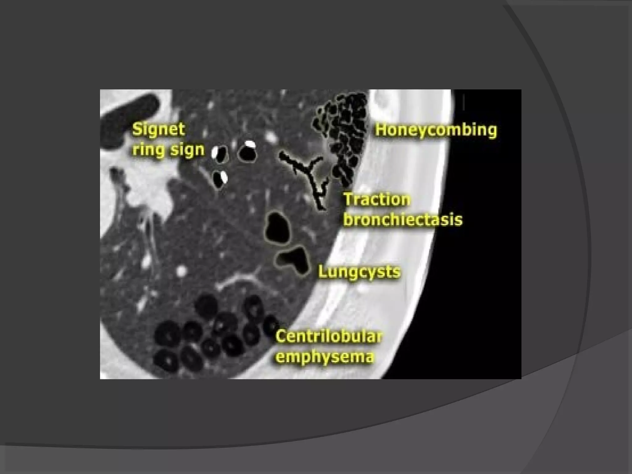 Hrct chest technique and interpretation | PPT