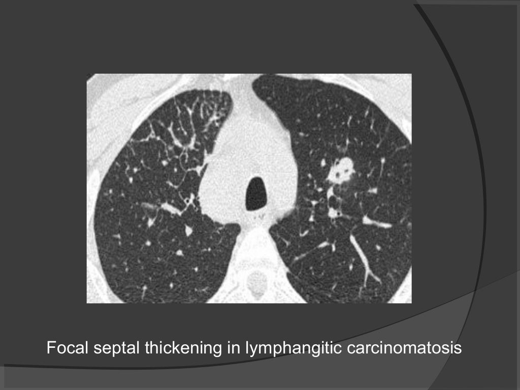 Hrct chest technique and interpretation