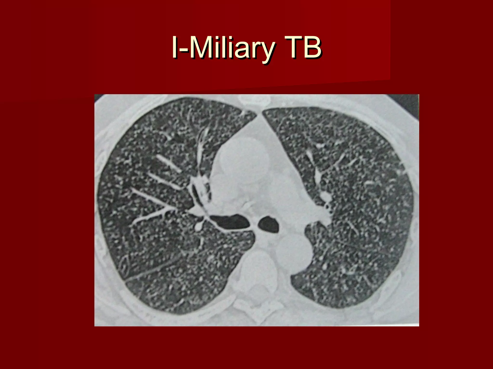 Hrct in diagnosis of diffuse lung diseases | PPT
