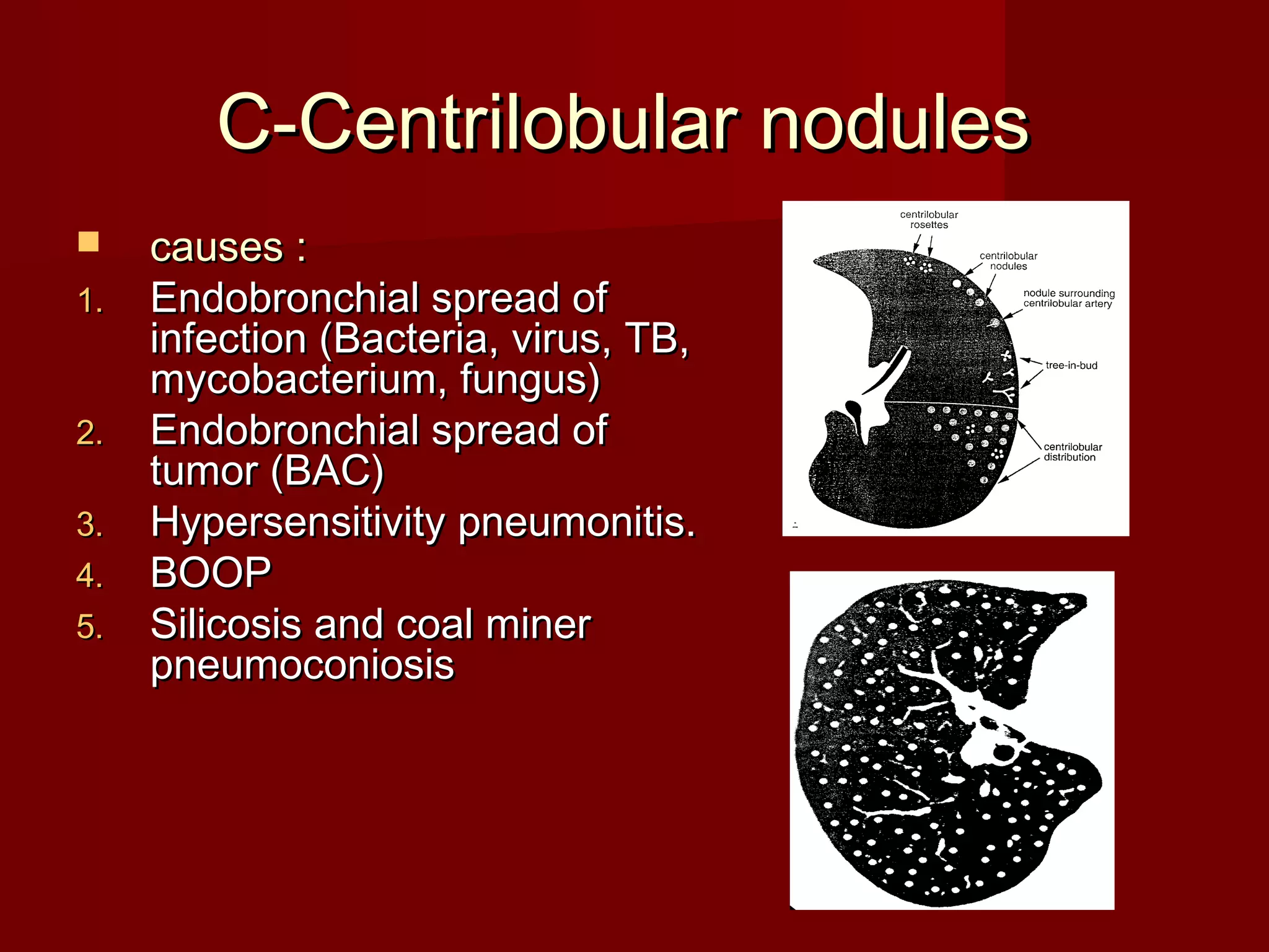 Hrct in diagnosis of diffuse lung diseases | PPT