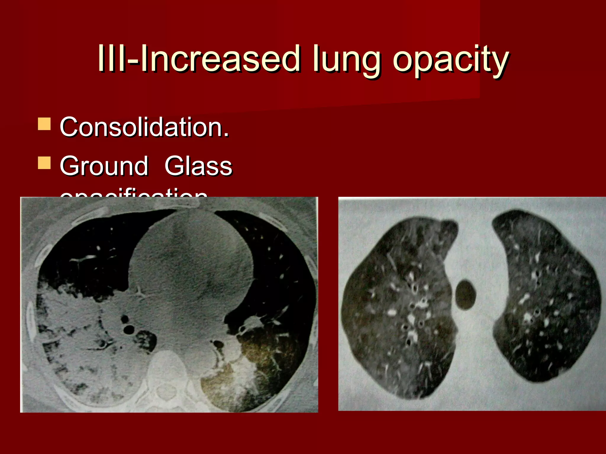 Hrct in diagnosis of diffuse lung diseases | PPT