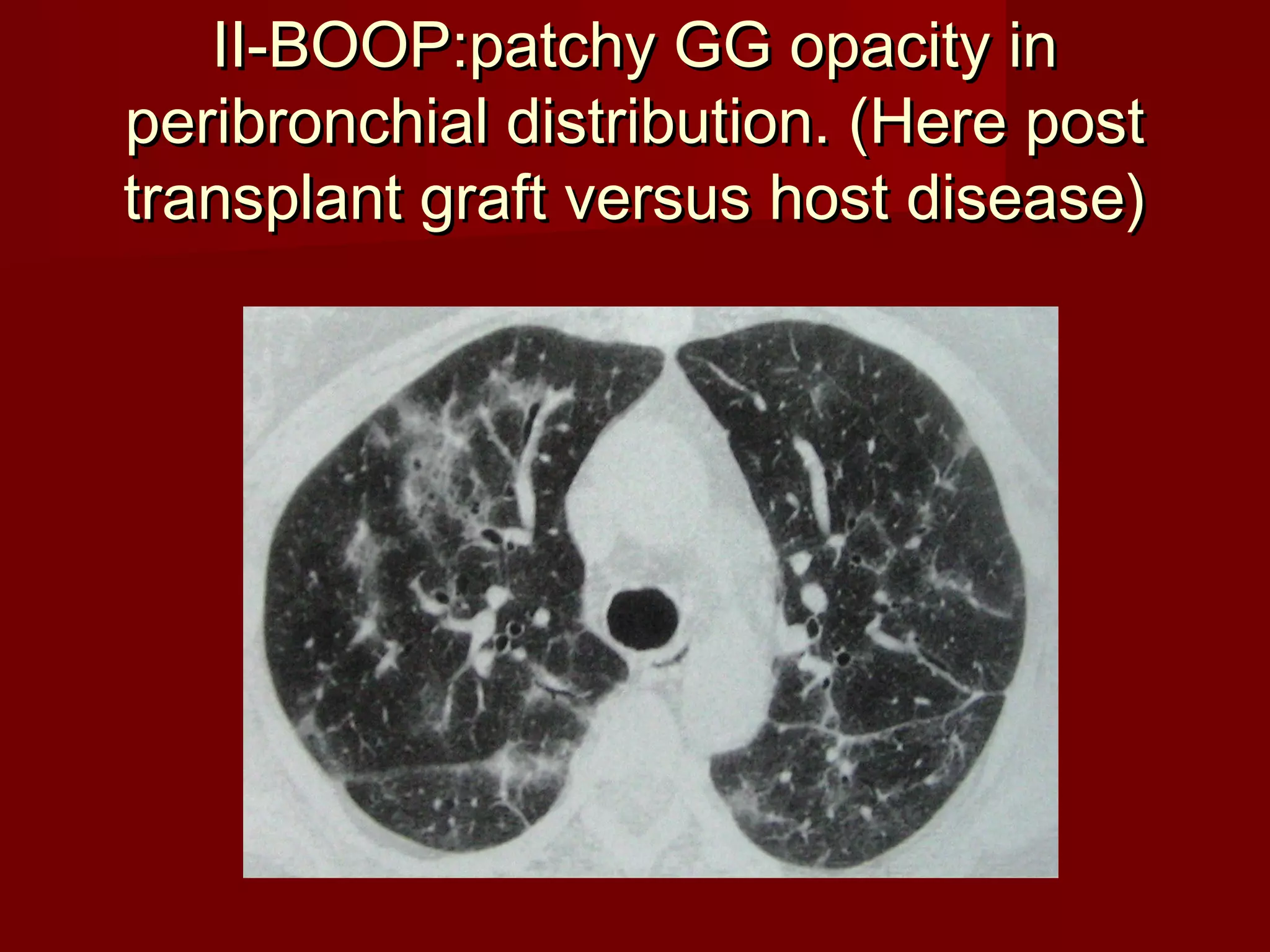 Hrct in diagnosis of diffuse lung diseases | PPT
