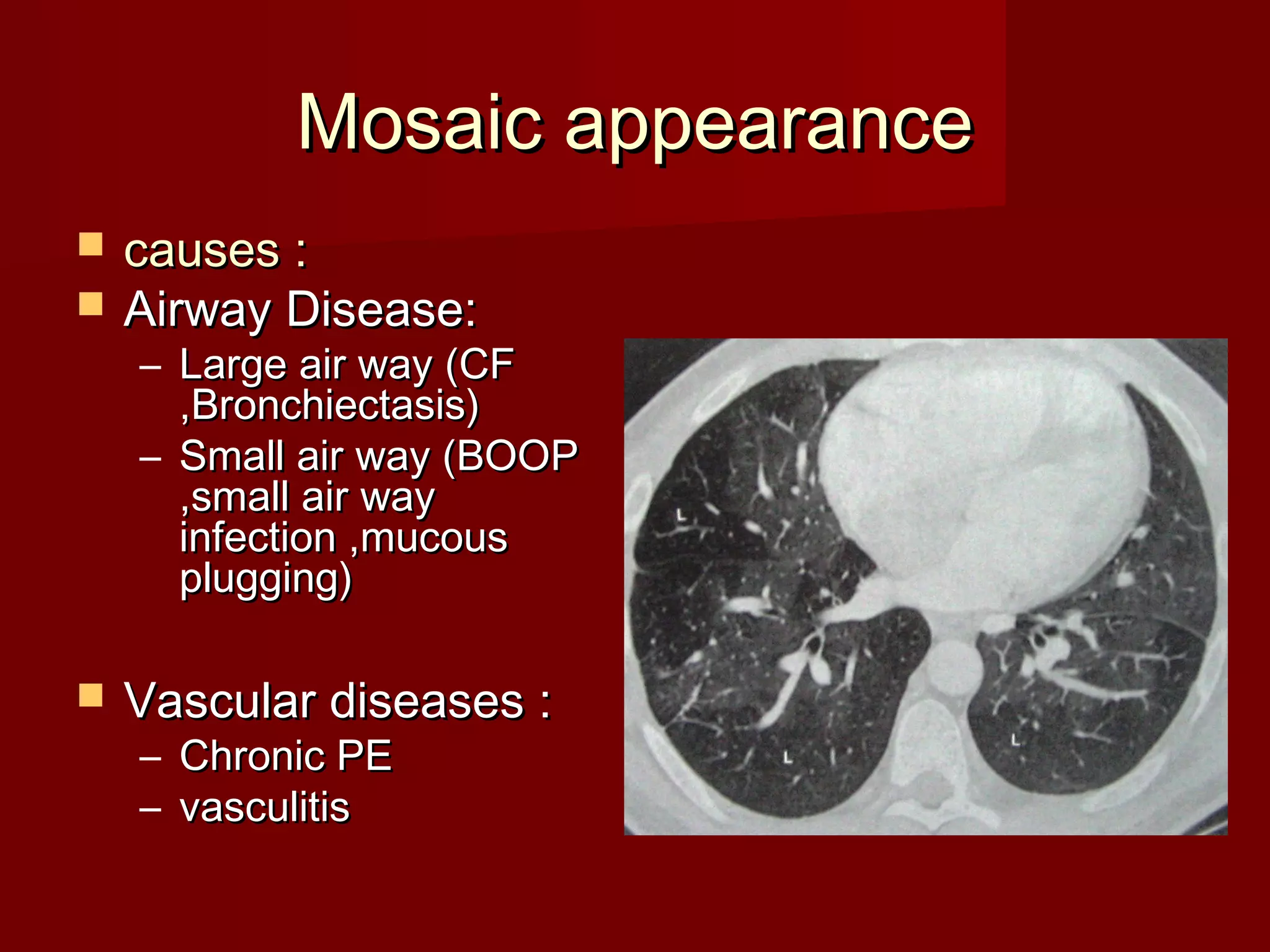 Hrct in diagnosis of diffuse lung diseases | PPT