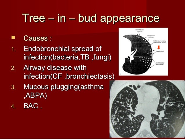 Hrct in diagnosis of diffuse lung diseases