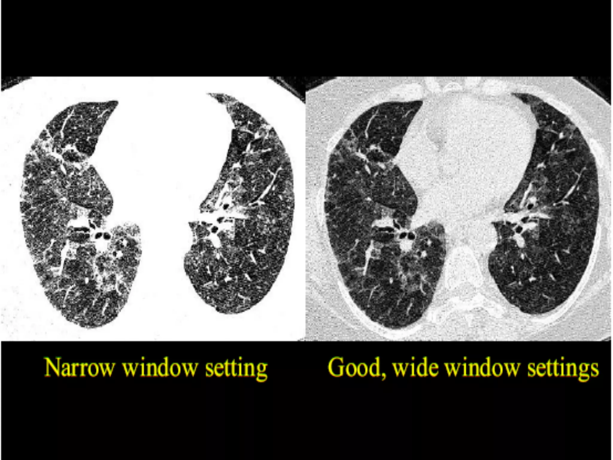 HRCT TECHNIQUE AND INTERPRETATION | PDF